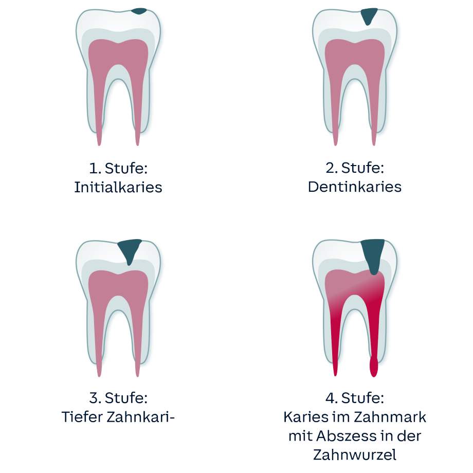 Karies vorbeugen und behandeln
