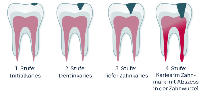 Karies vorbeugen und behandeln