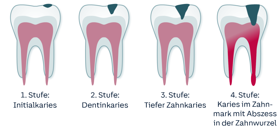 Karies vorbeugen und behandeln